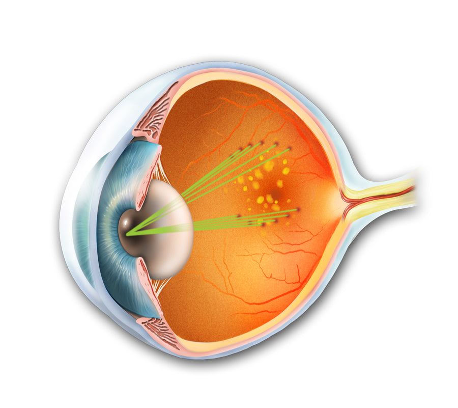 eye laser illustration – Berry.dk